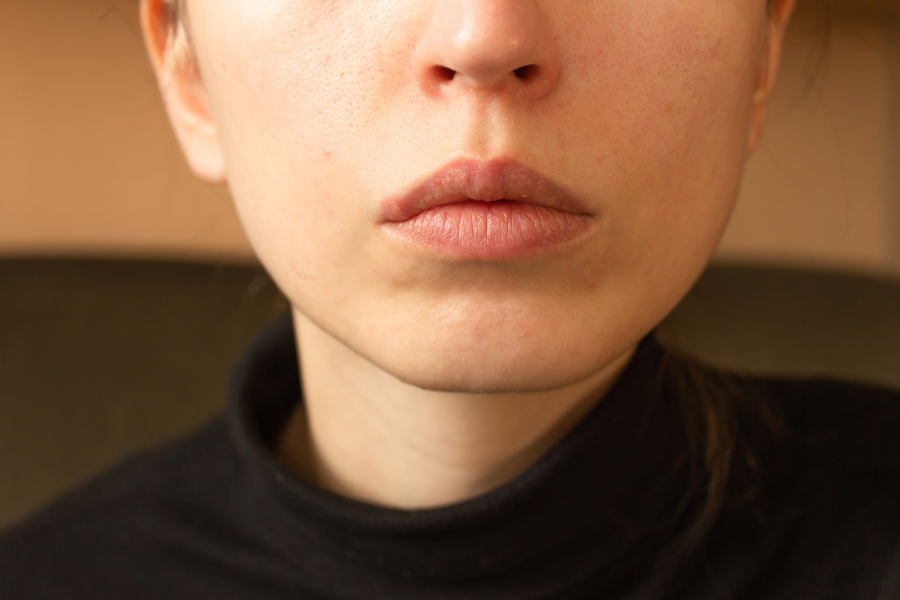 Pimples Vs. Herpes: 7 Signs To Tell The Difference