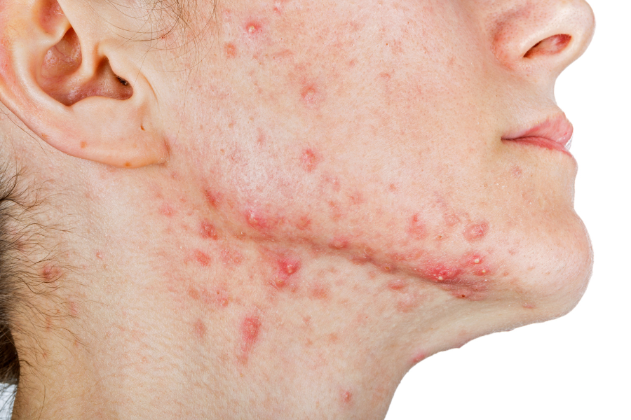 7 Expert Tips On When To See A Dermatologist For Acne