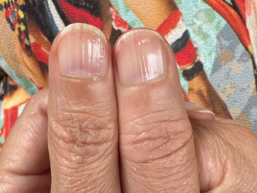 Are Your Nails Trying to Tell You Something? Beware of These Vertical ...
