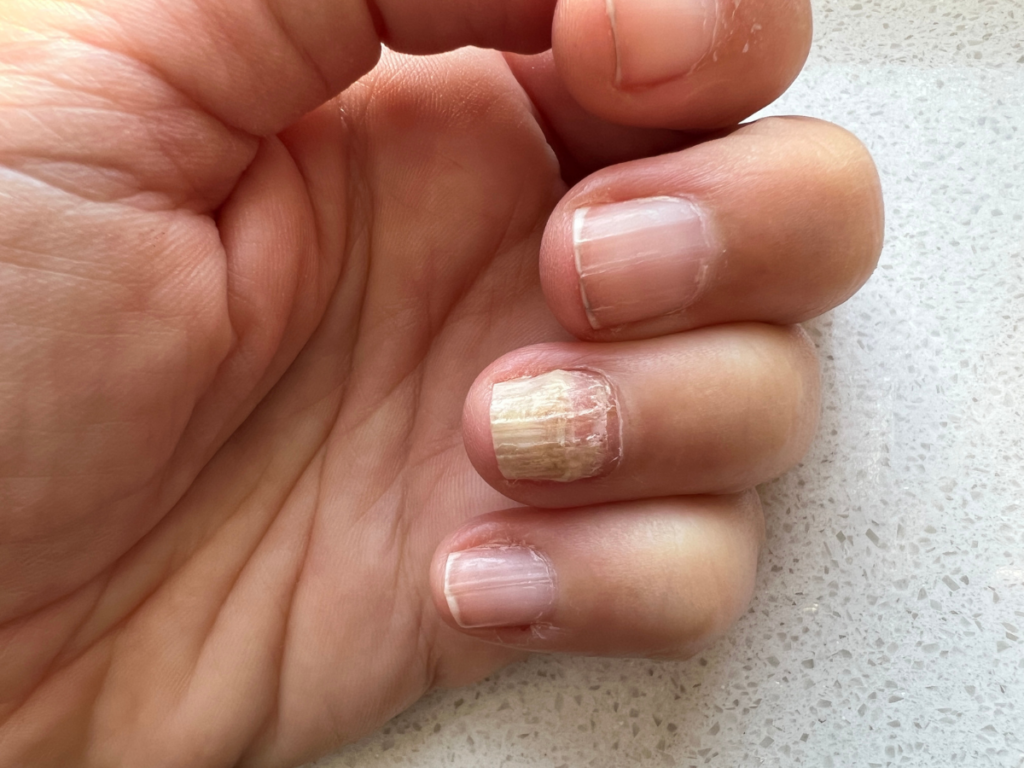 Are Your Nails Trying to Tell You Something? Beware of These Vertical ...