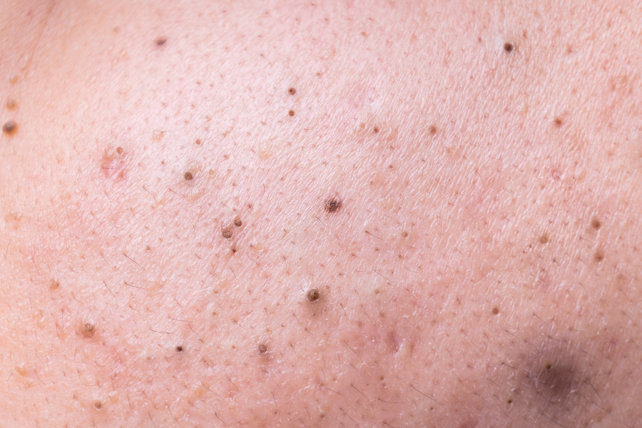 Say Goodbye To Blackheads With These 6 Simple Homemade Remedies