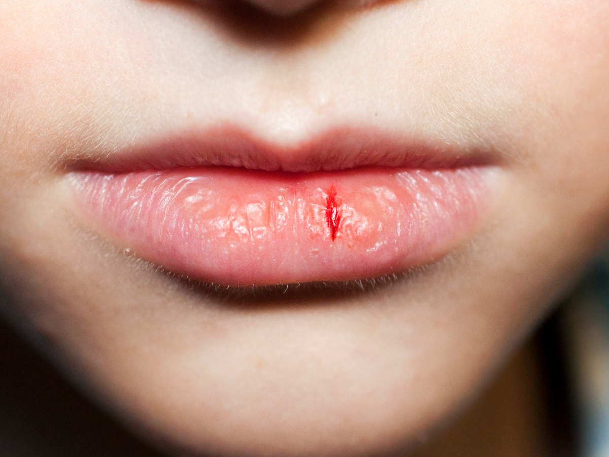 Suffering from Severe Chapped Lips? Try These 8 Natural Home Remedies ...